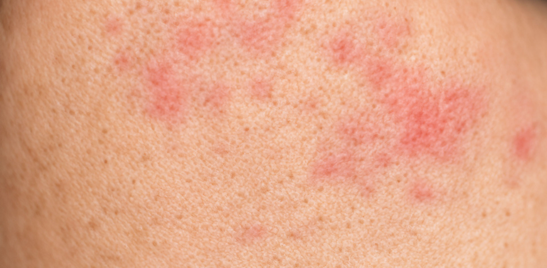 Mild Contact Dermatitis