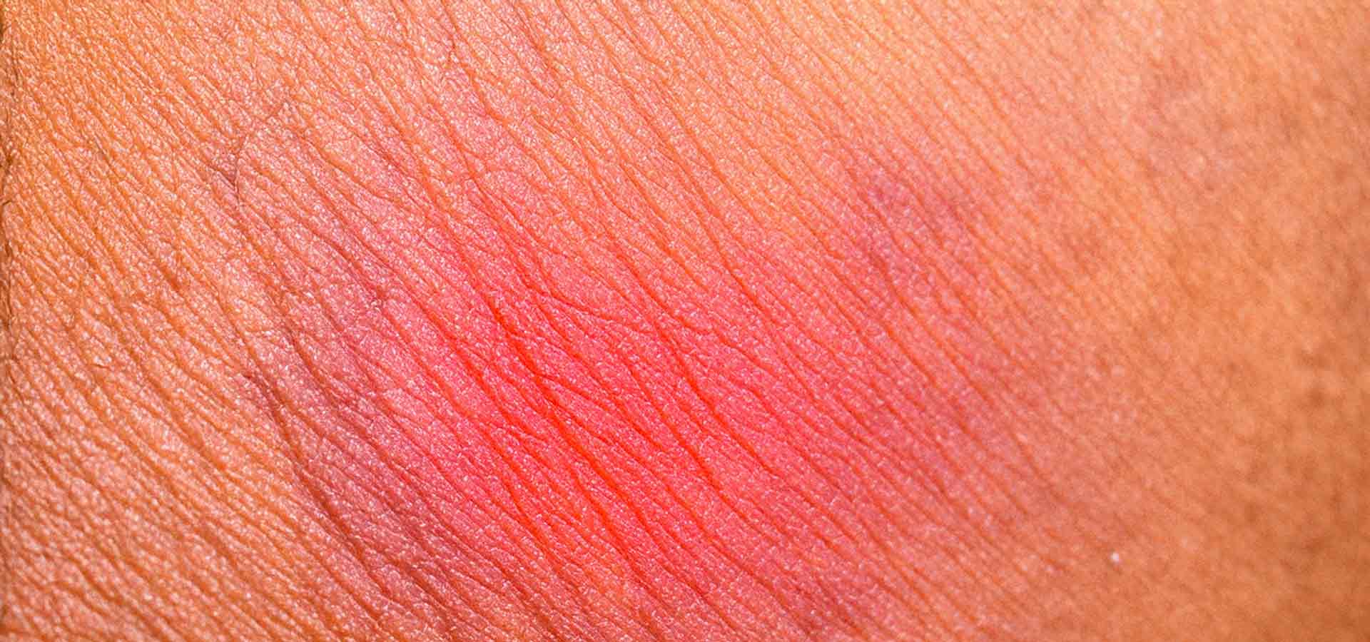 Skin Inflammation: Appearance, Causes & Management | E45