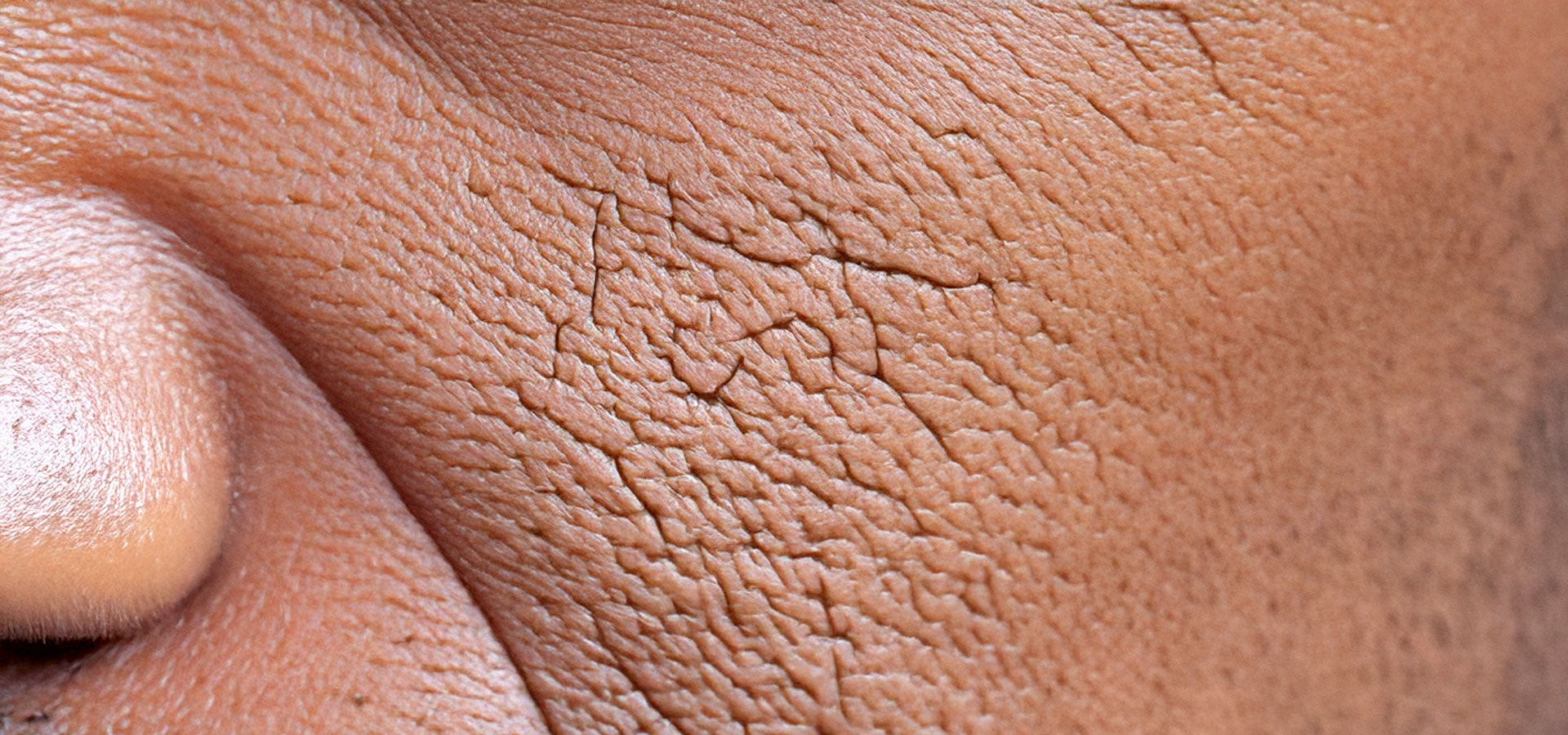 Cracked skin: Causes, symptoms and treatment