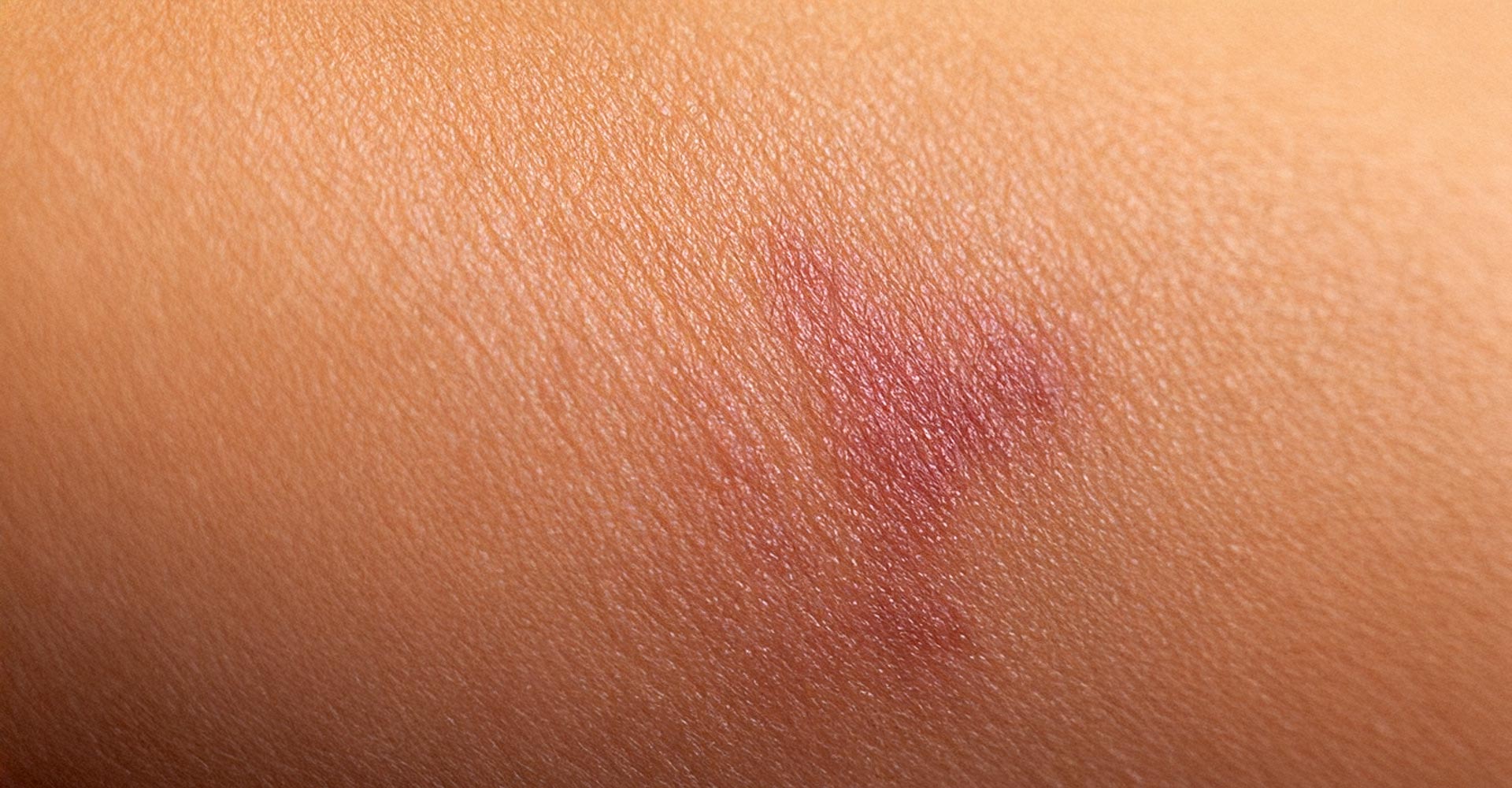 Irritated skin | E45