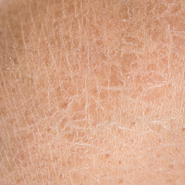 Ichthyosis - E45